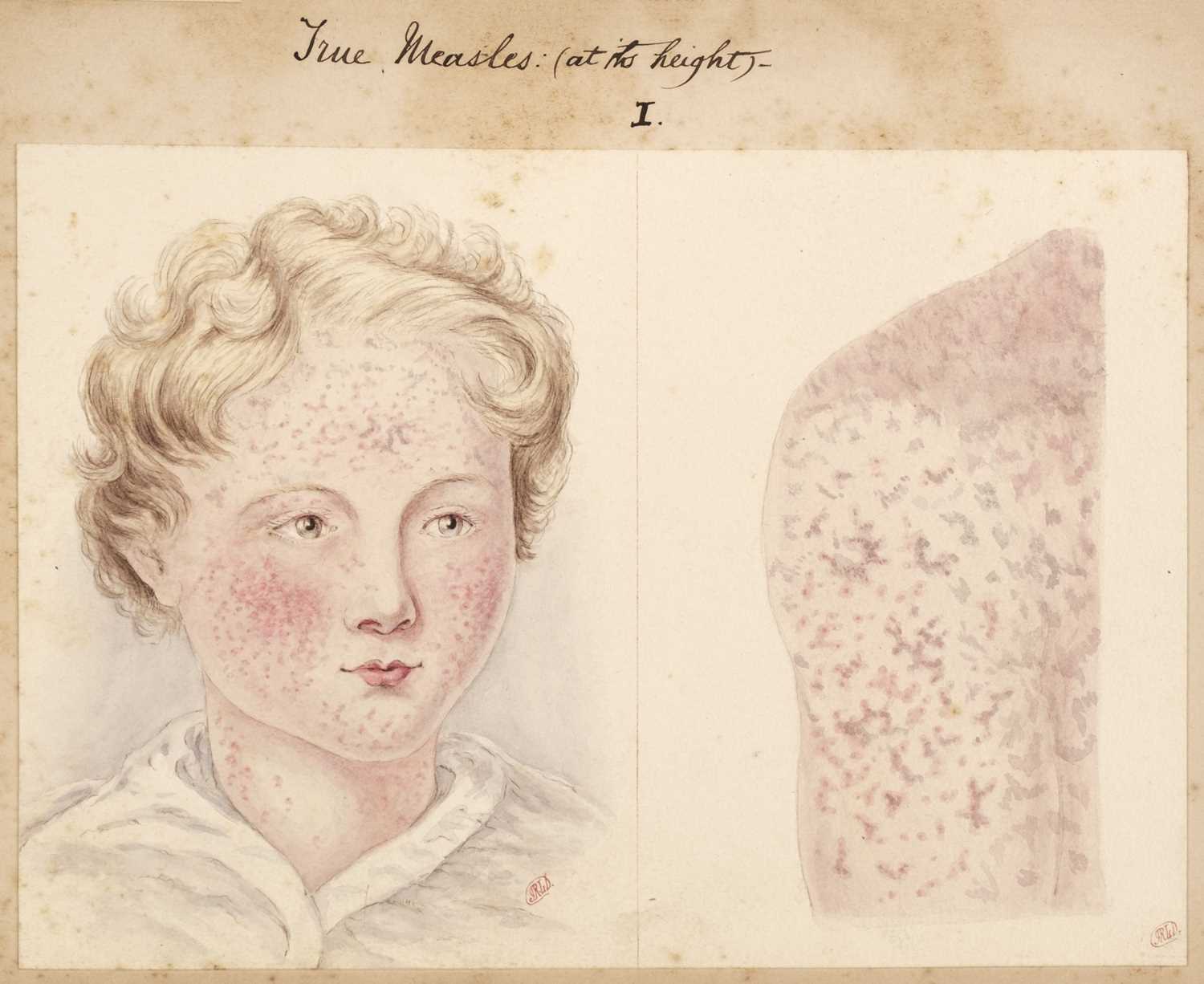 Lot 355 - Measles Manuscript. Essay on Measles, German